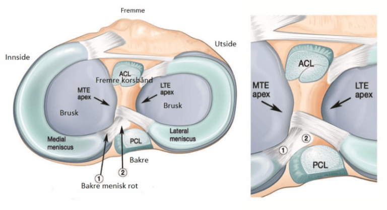Meniskskade – bør jeg operere kneet? - LFI